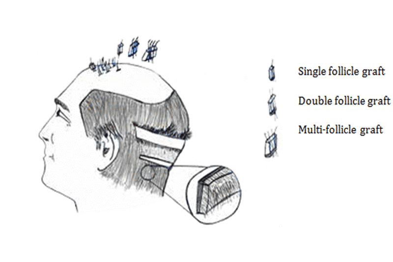 Hair Fibre - Dr Amit Gupta plastic surgeon In Delhi , Gurgaon (India)